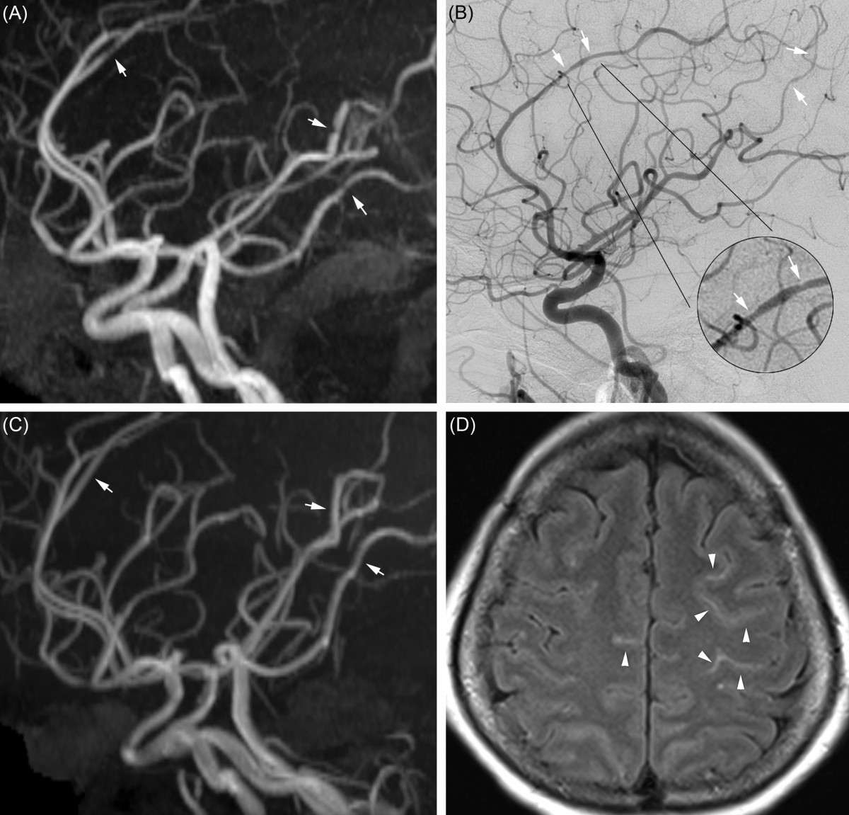 A common cause of sudden and thunderclap headaches: reversible cerebral vasoconstriction ...
