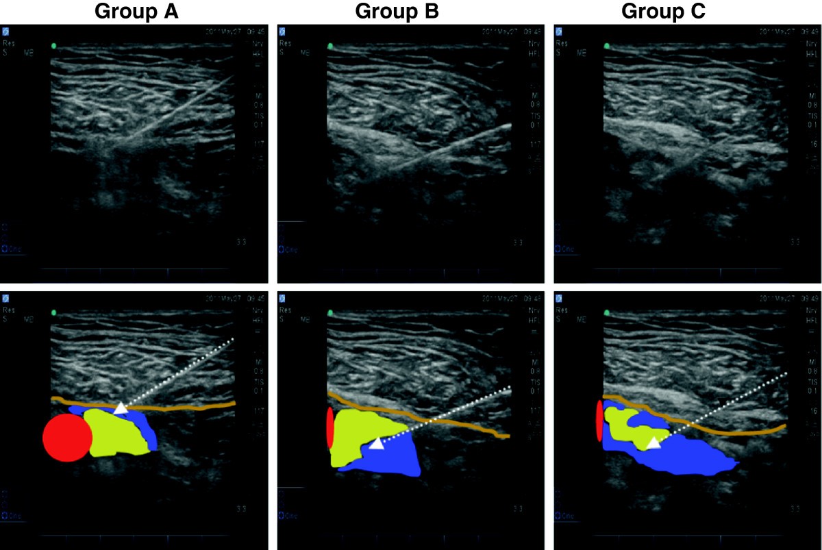A comparison of three techniques (local anesthetic deposited ...