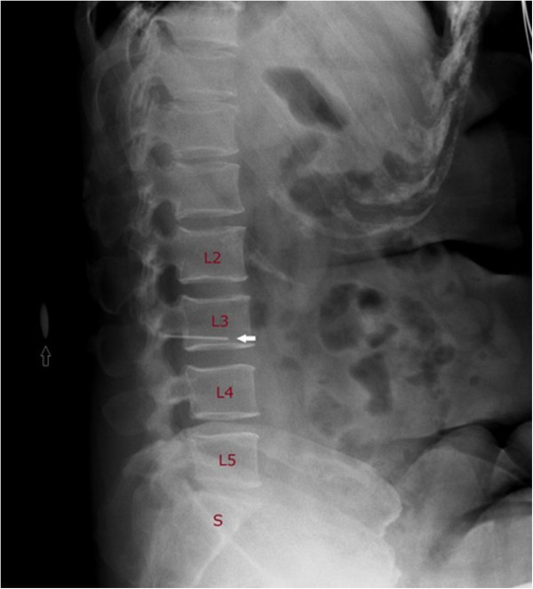 Abdominal circumference but not the degree of lumbar flexion affects ...