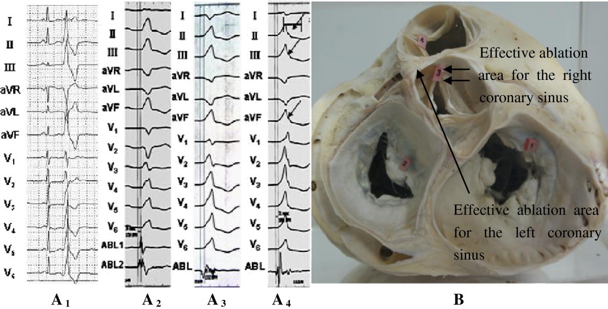 Electrocardiogram features of premature ventricular contractions ...