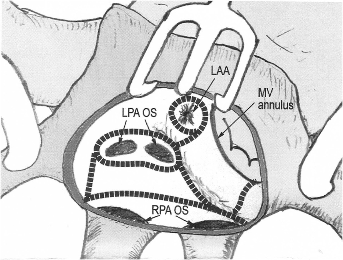 Preoperative risk factor analysis of postoperative stroke after Cox-maze procedure with mitral ...