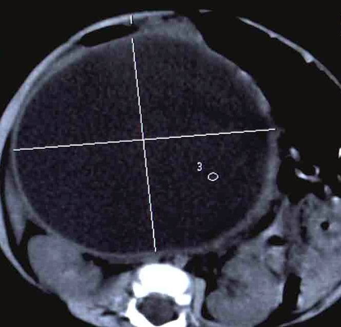 Surgical treatment of congenital biliary duct cyst | BMC ...
