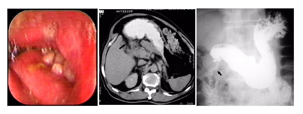 Primary gastric tuberculosis – report of 5 cases | BMC Gastroenterology ...