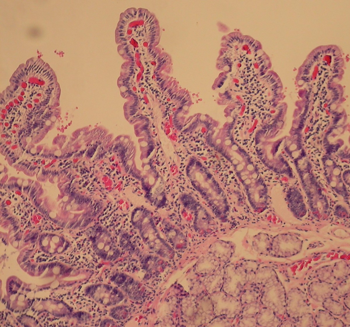 Importance of duodenal bulb biopsies in children for diagnosis of ...