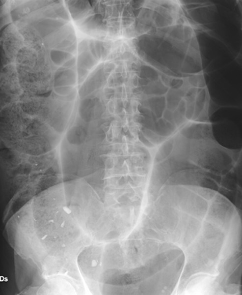 Sigmoid volvulus showing a "whirl sign" on computed tomography | BMC ...