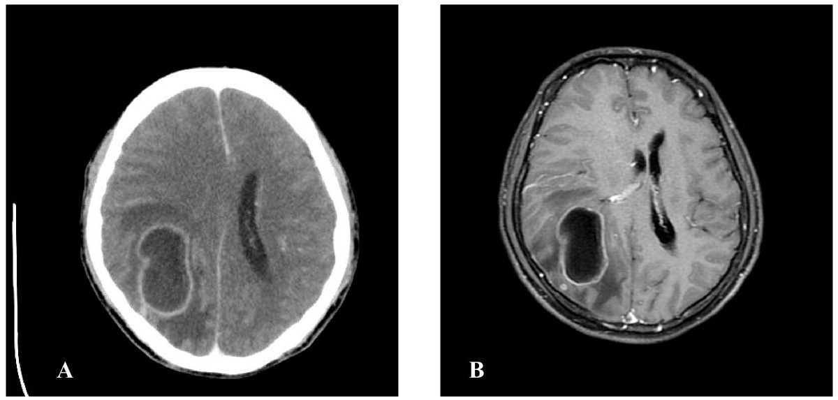 Kocuria varians infection associated with brain abscess: A case report ...
