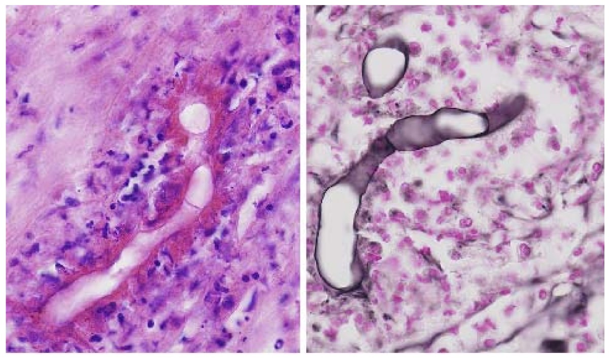 A fatal pseudo-tumour: disseminated basidiobolomycosis | BMC Infectious ...