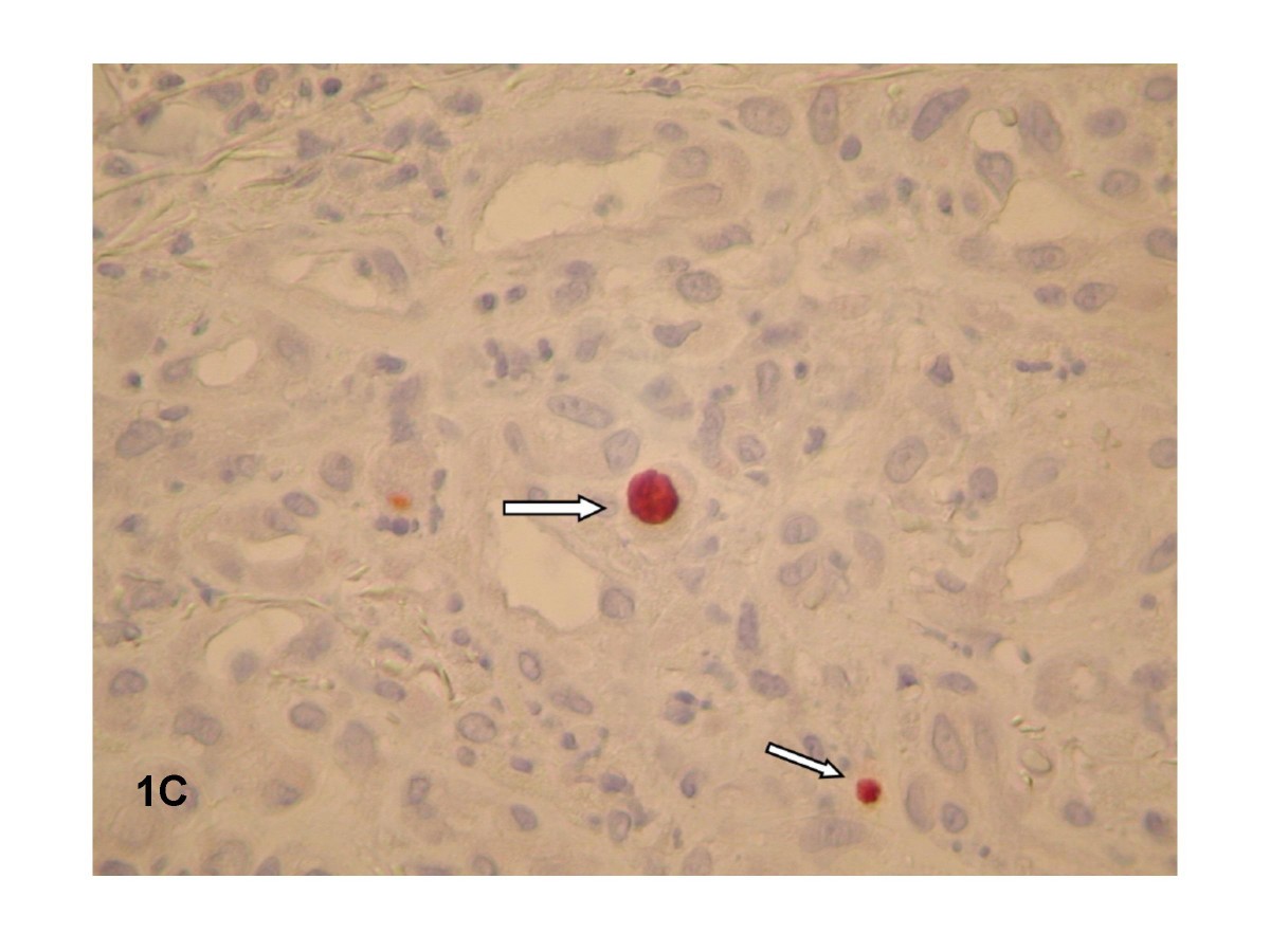 Bartonella quintana coinfection with Mycobacterium aviumcomplex and CMV ...