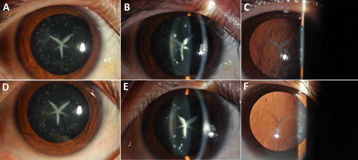 A novel MIPgene mutation associated with autosomal dominant congenital ...