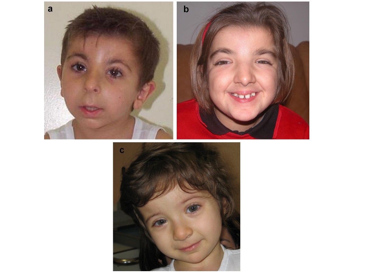 Rubinstein-Taybi Syndrome: spectrum of CREBBP mutations in Italian ...