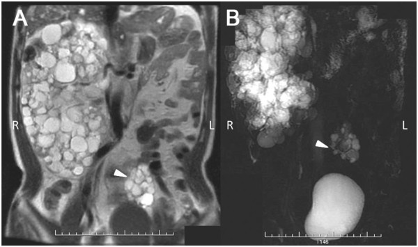 Autosomal dominant polycystic kidney disease with ectopic unilateral ...