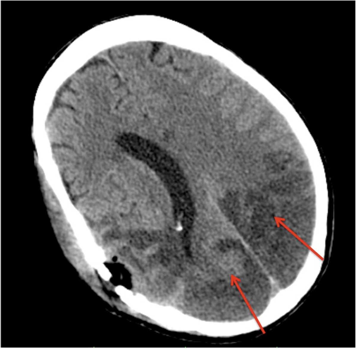 Progressive multifocal cerebral infarction in a young kidney transplant ...