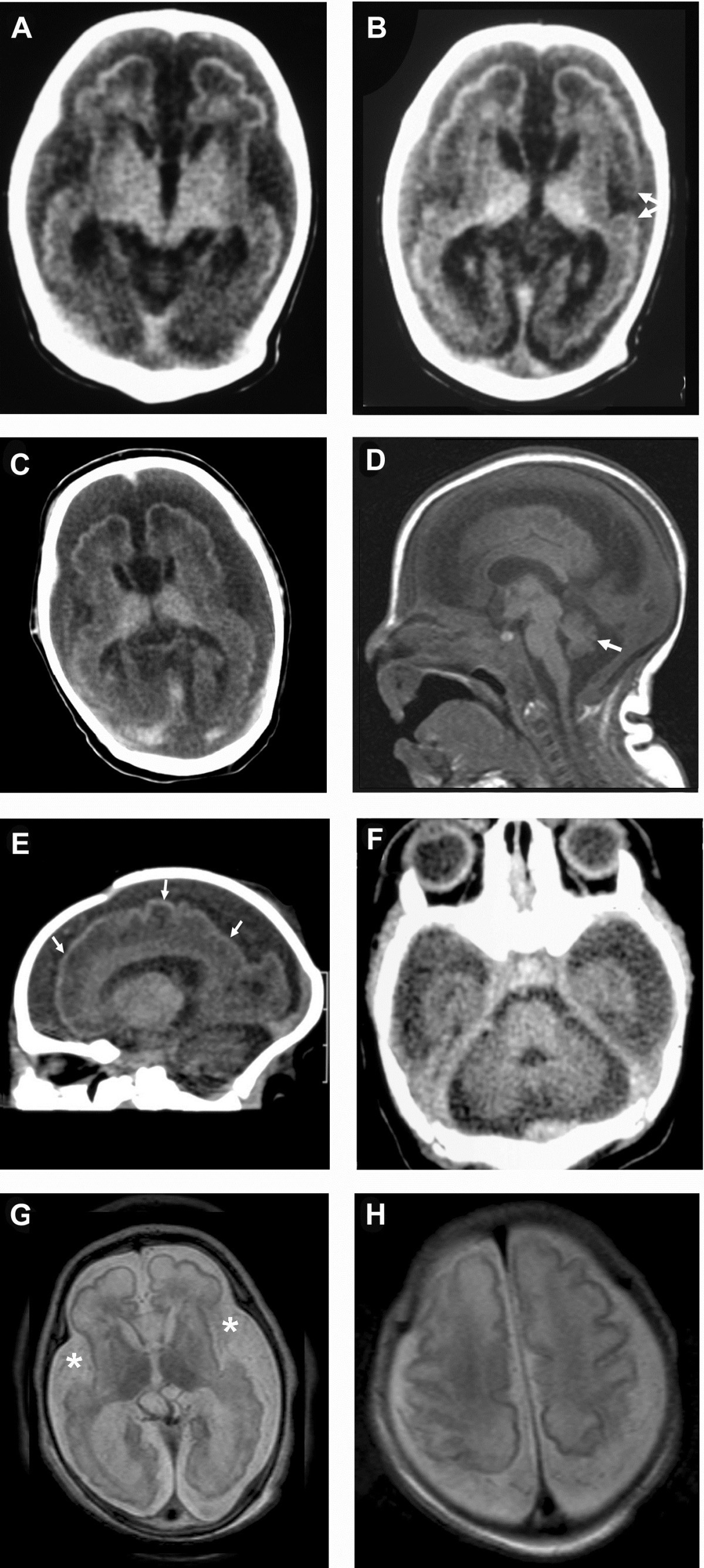 A novel syndrome of lethal familial hyperekplexia associated with brain ...