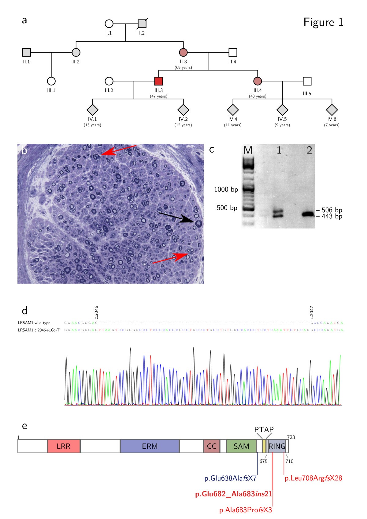A novel mutation in LRSAM1 causes axonal Charcot-Marie-Tooth disease ...