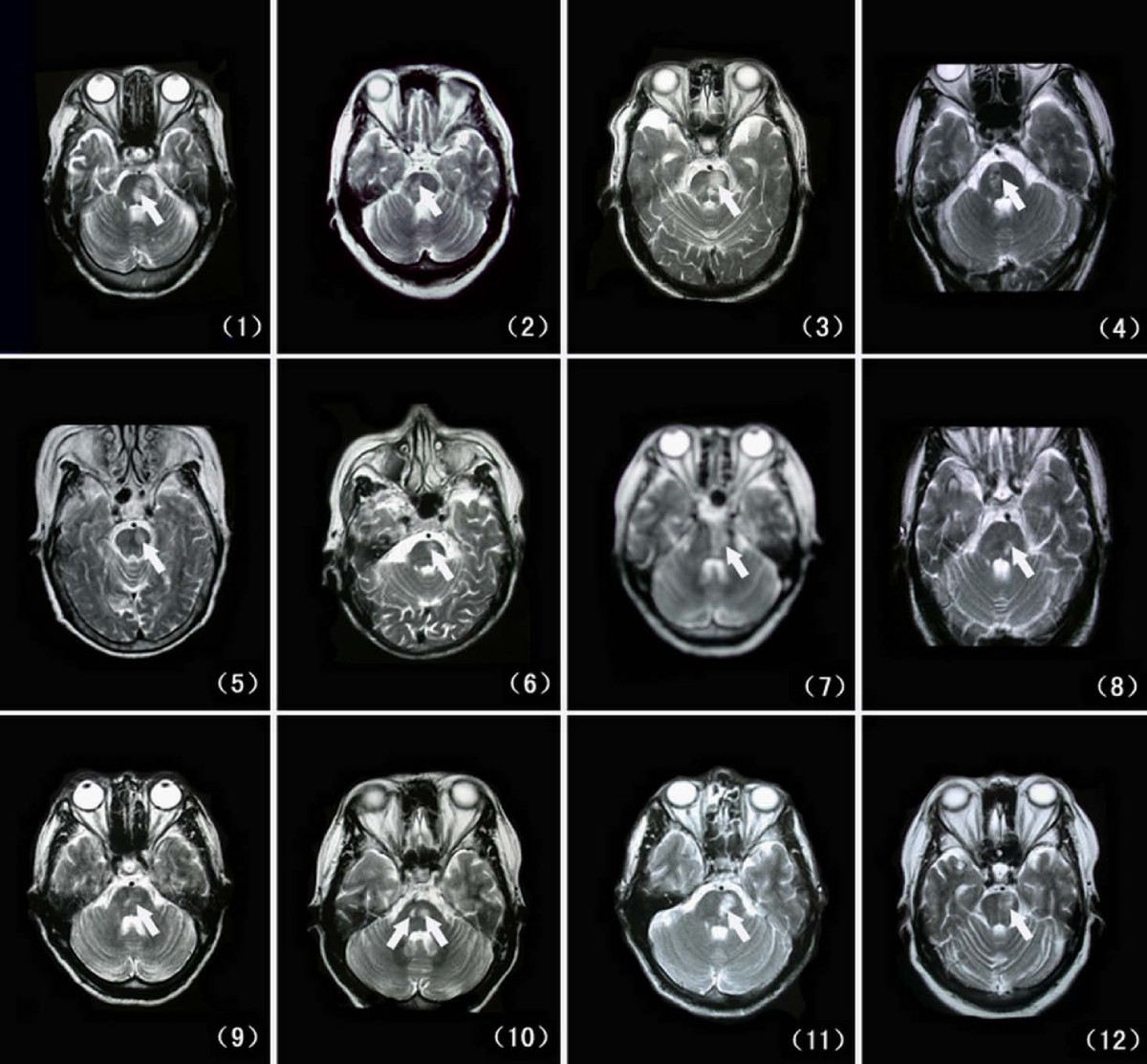 Pontine infarction with pure motor hemiparesis or hemiplegia: A ...