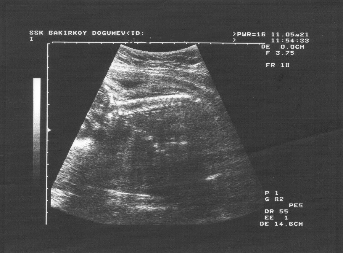 Prenatal diagnosis of Caudal Regression Syndrome : a case report | BMC ...