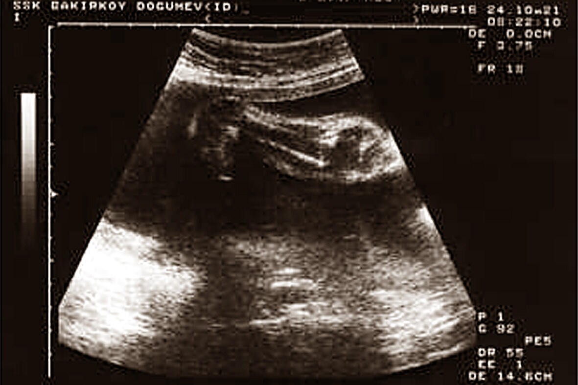 Prenatal diagnosis of Wolf-Hirschhorn syndrome (4p-) in association ...