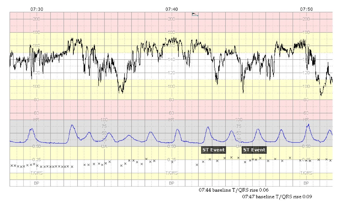 A randomised clinical trial on cardiotocography plus fetal blood ...