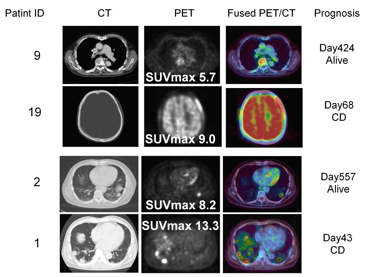 Impact of maximum Standardized Uptake Value (SUVmax) evaluated by 18-Fluoro-2-deoxy-D-glucose ...