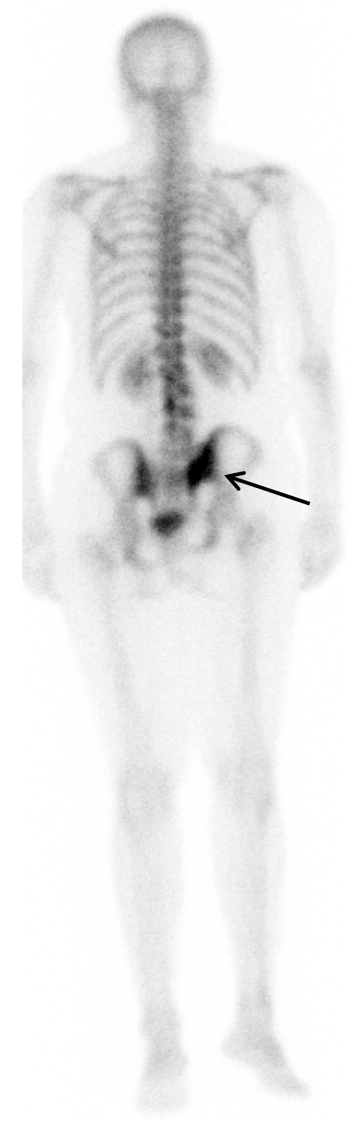 Does colon cancer ever metastasize to bone first? a temporal analysis ...