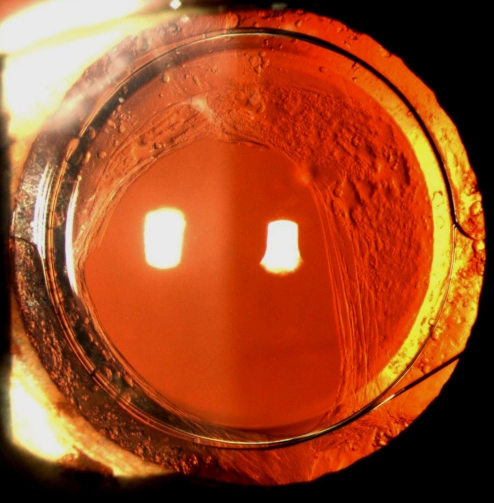 Intermediate term follow-up after a single-piece-acrylic intraocular ...