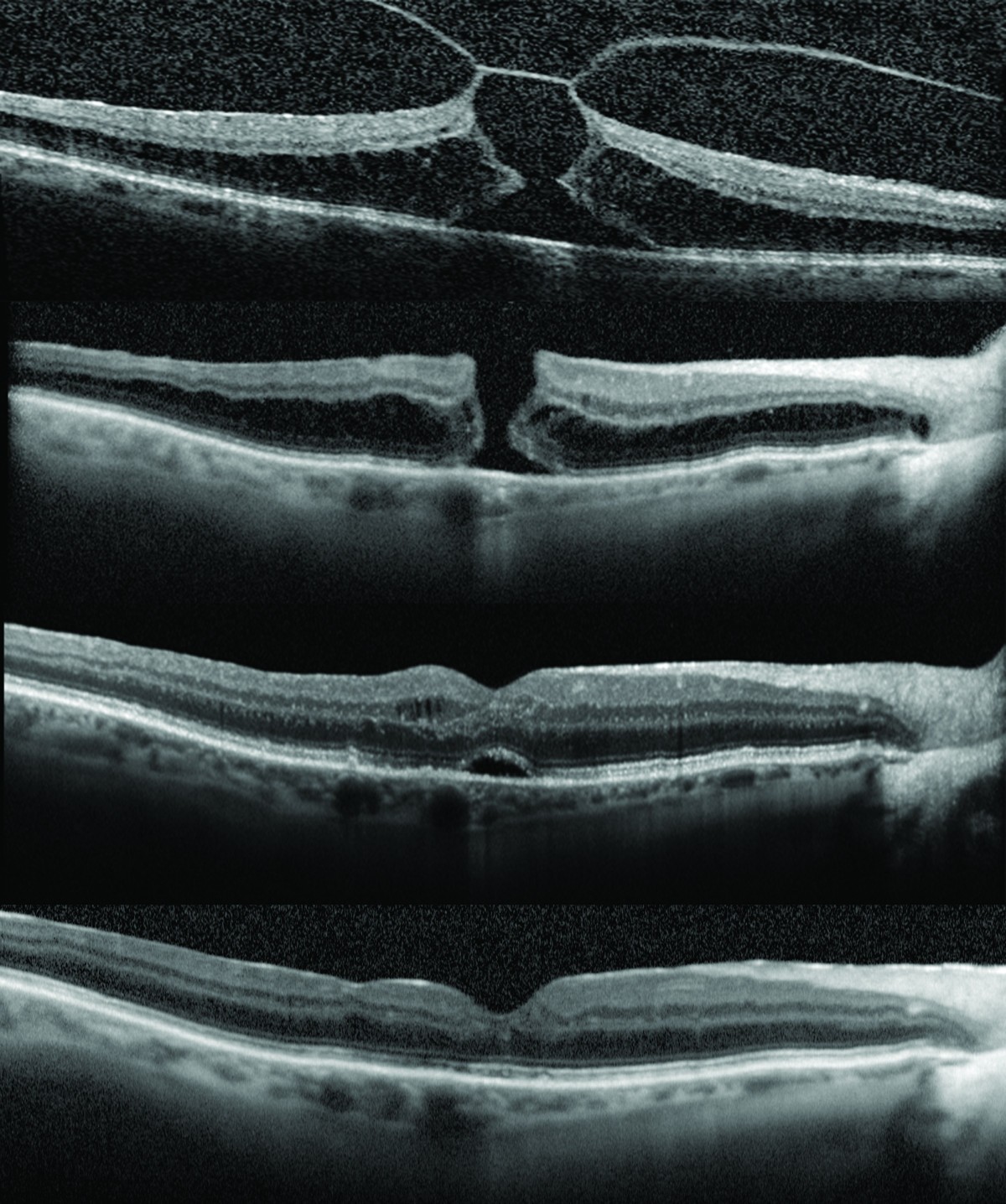 Macular hole formation and spontaneous closure after vitrectomy for ...