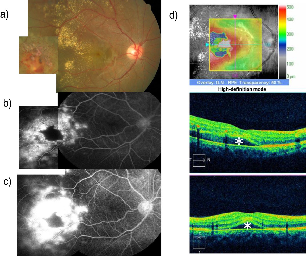 Combined treatment for Coats’ disease: retinal laser photocoagulation ...