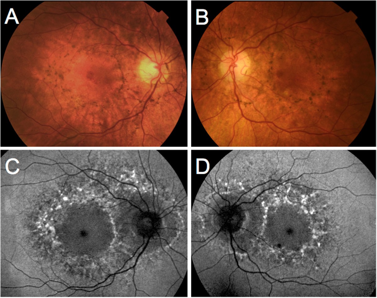 Macular dystrophy associated with the mitochondrial DNA A3243G mutation ...