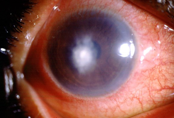 Is Microsporidial keratitis an emerging cause of stromal keratitis? – a ...