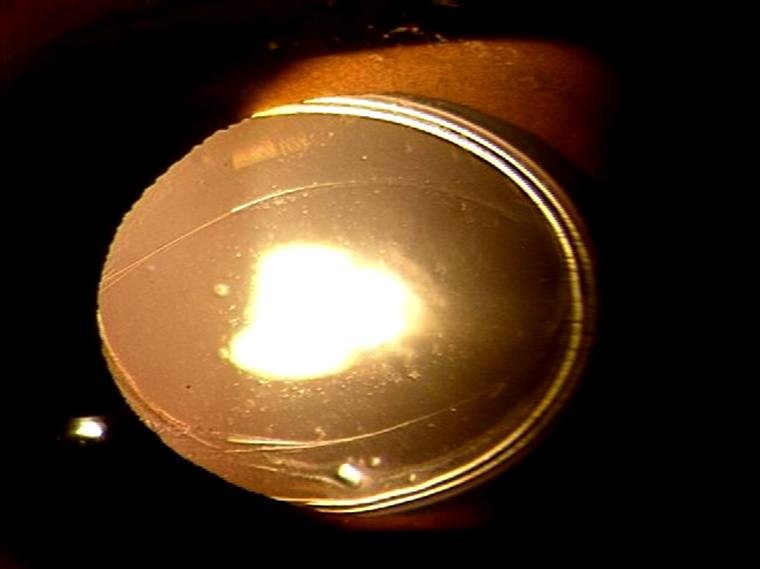 Efficacy of trypan blue in posterior capsulorhexis with optic capture ...