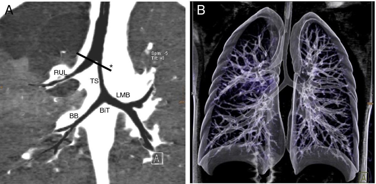 Bridging bronchus - a rare cause of recurrent wheezy bronchitis | BMC ...
