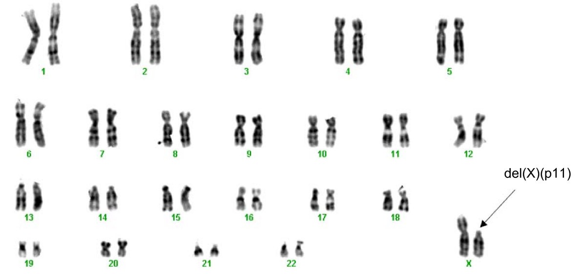 A del(X)(p11) carrying SRY sequences in an infant with ambiguous ...