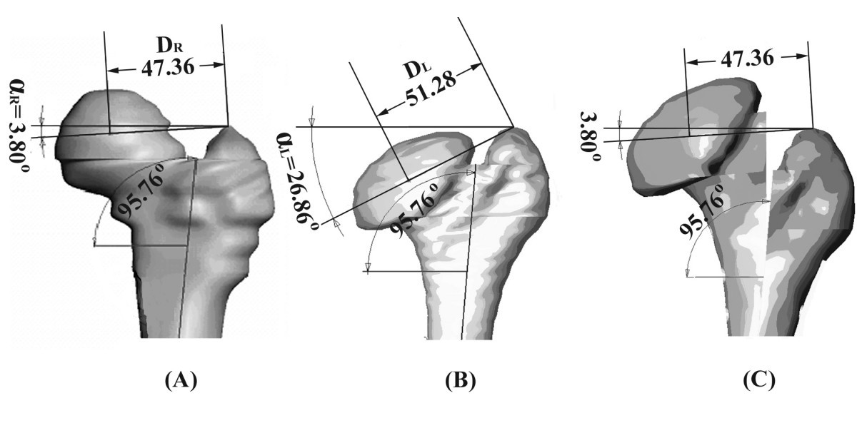 Biomechanical optimization of different fixation modes for a proximal ...
