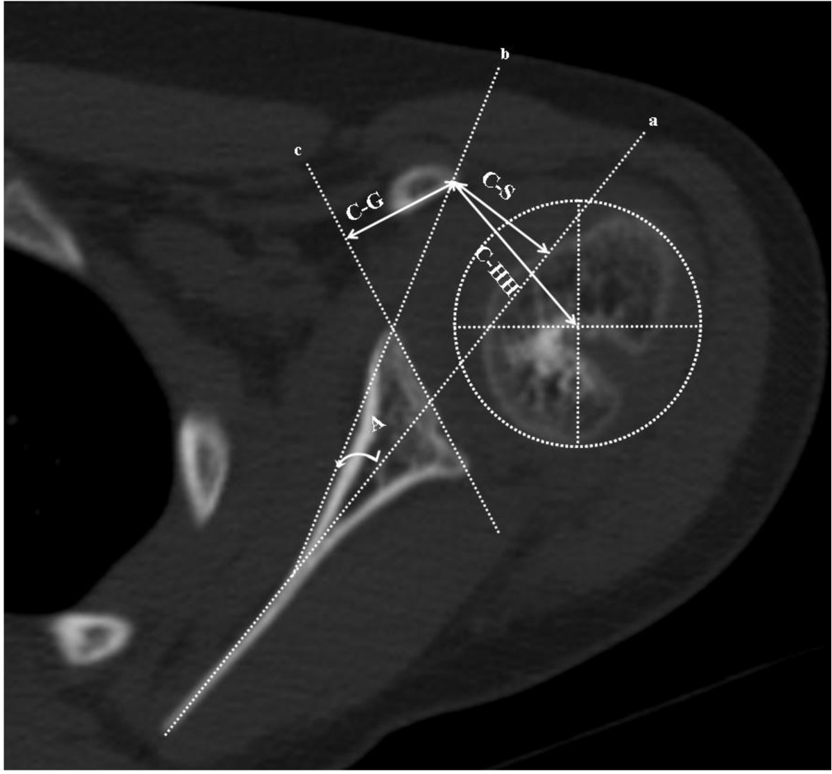Coracoid Abnormalities and Their Relationship with Glenohumeral ...