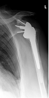 Infraglenoidal scapular notching in reverse total shoulder replacement ...