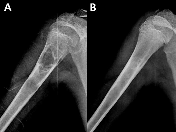 Minimal invasive surgery for unicameral bone cyst using demineralized ...