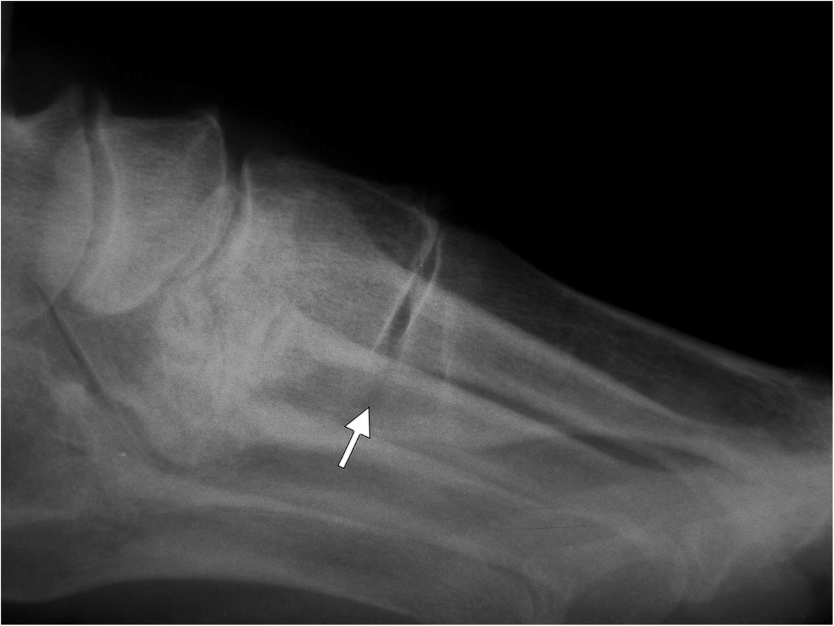 Hypermobility of the first metatarsal bone in patients with Rheumatoid ...