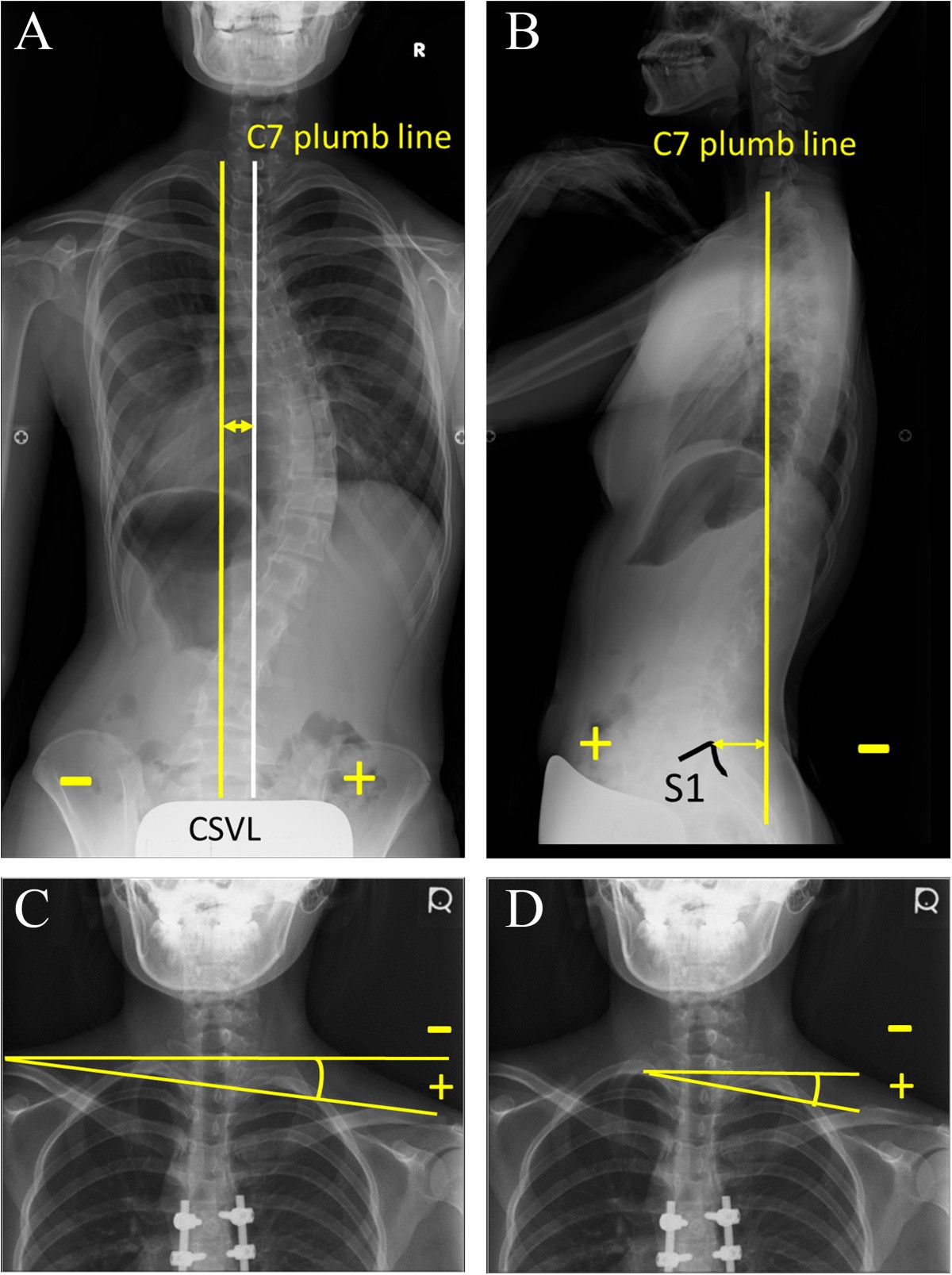 Postoperative shoulder imbalance in Lenke Type 1A adolescent idiopathic ...