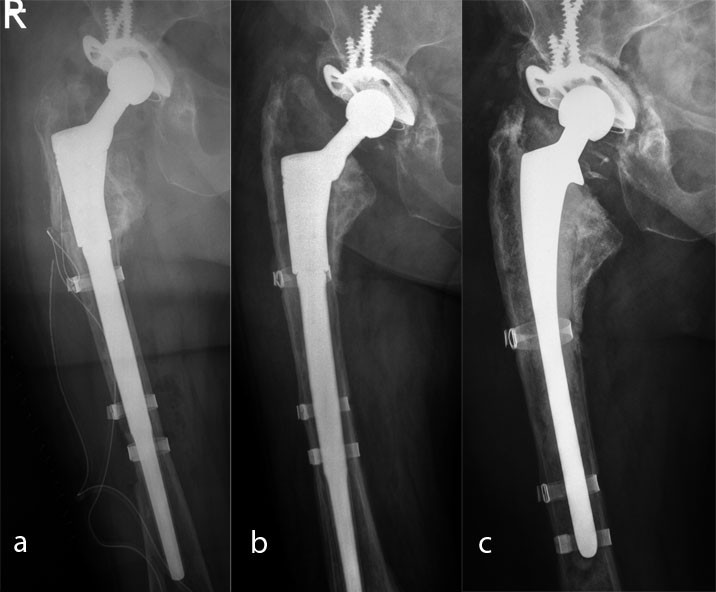 Two-stage hip revision arthroplasty with a hexagonal modular cementless ...