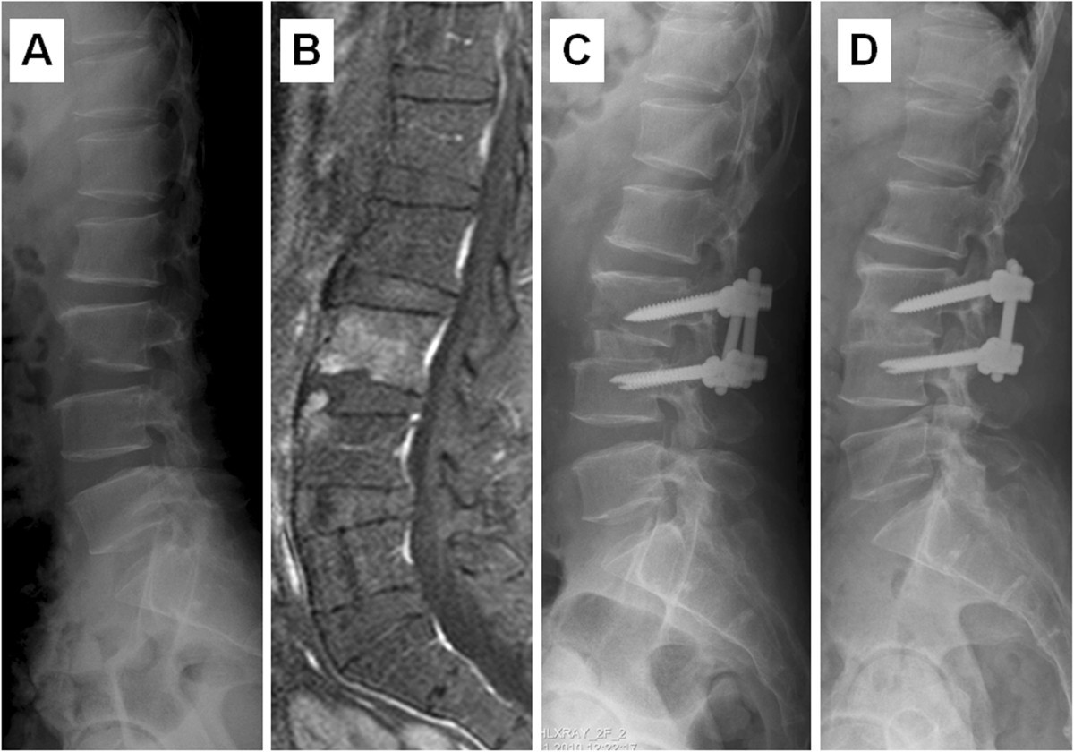 Comparison of two-stage open versus percutaneous pedicle screw fixation ...