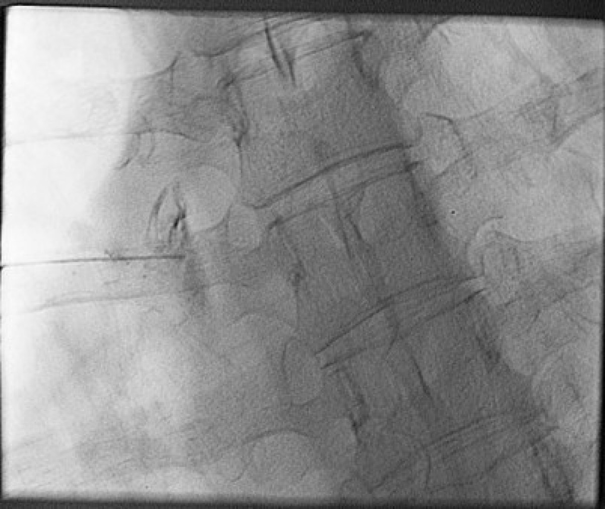 Costotransverse Joint Injection