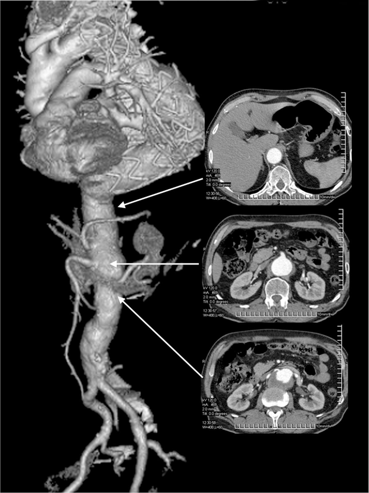 Treatment of a rapidly expanding thoracoabdominal aortic aneurysm after ...