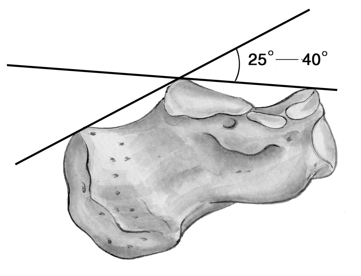 Bohler’s angle’s role in assessing the injury severity and functional ...