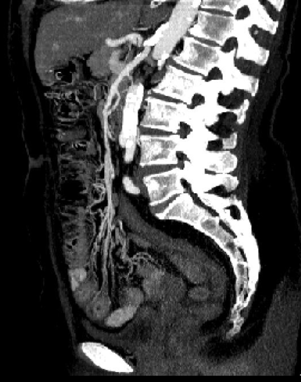 Mesenteric ischemia: the importance of differential diagnosis for the ...