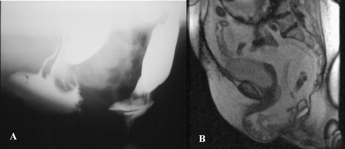 Role of conventional radiology and MRi defecography of pelvic floor ...