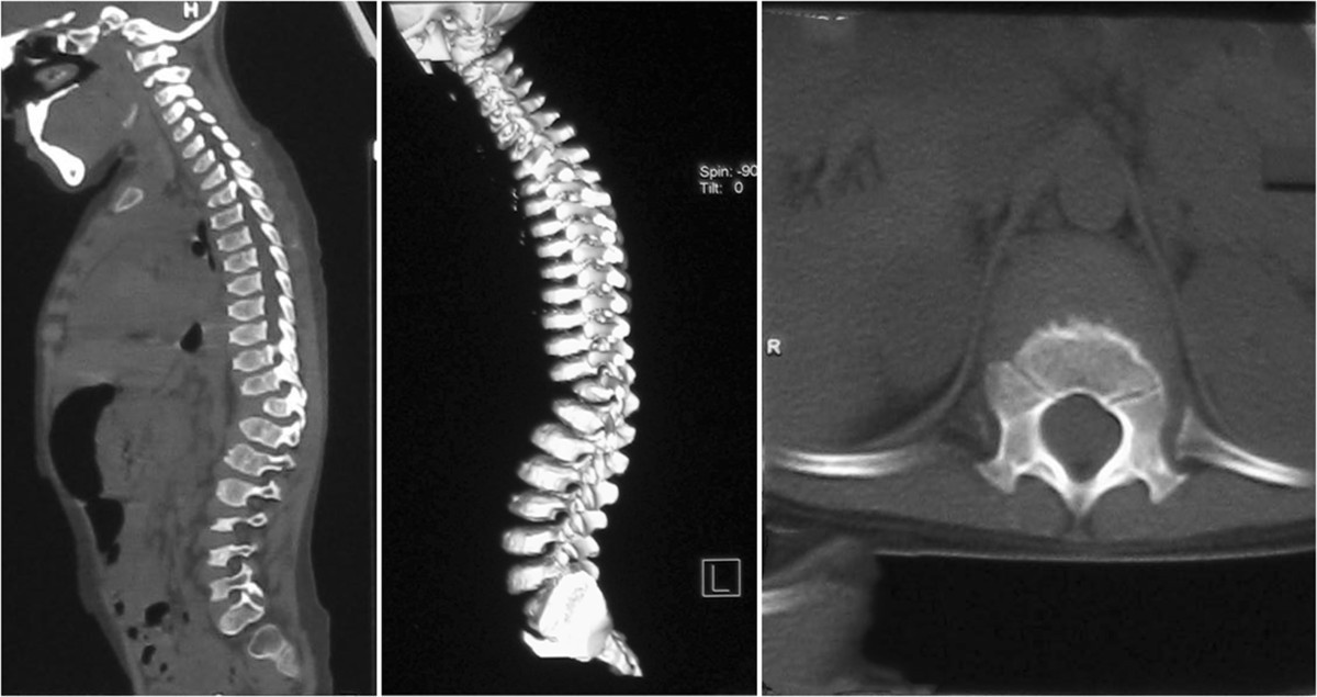 Congential scoliosis in Wilson’s disease: case report and review of the ...