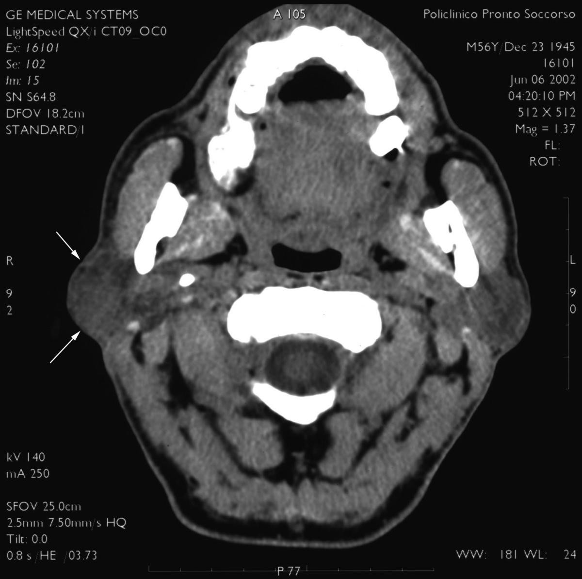 Poorly differentiated carcinoma arising from adenolymphoma of the ...