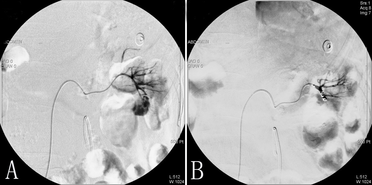 Metachronous renal vein and artery injure after percutaneous ...
