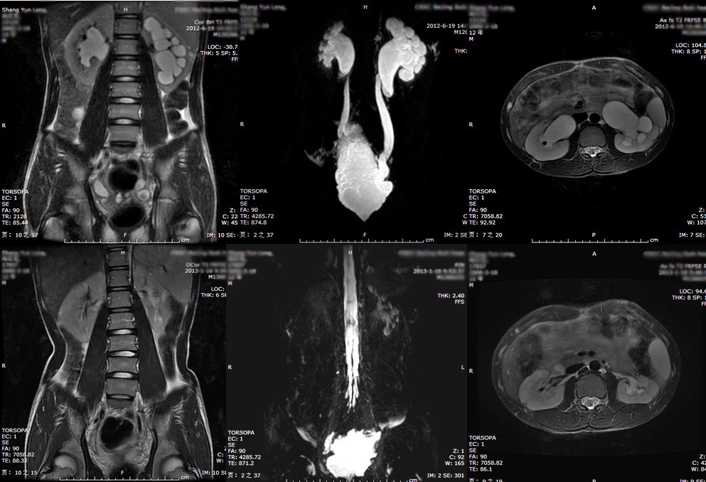 New grading system for upper urinary tract dilation using magnetic ...