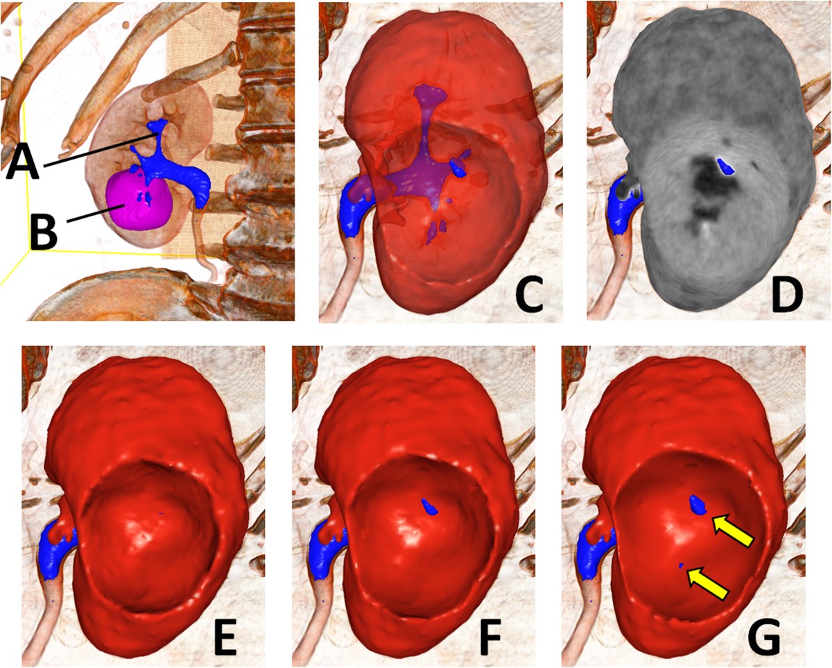 Prediction of open urinary tract in laparoscopic partial nephrectomy by ...
